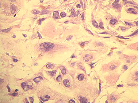 Georgia Dermatopathology Associates - Clinically Amelanotic Malignant ...